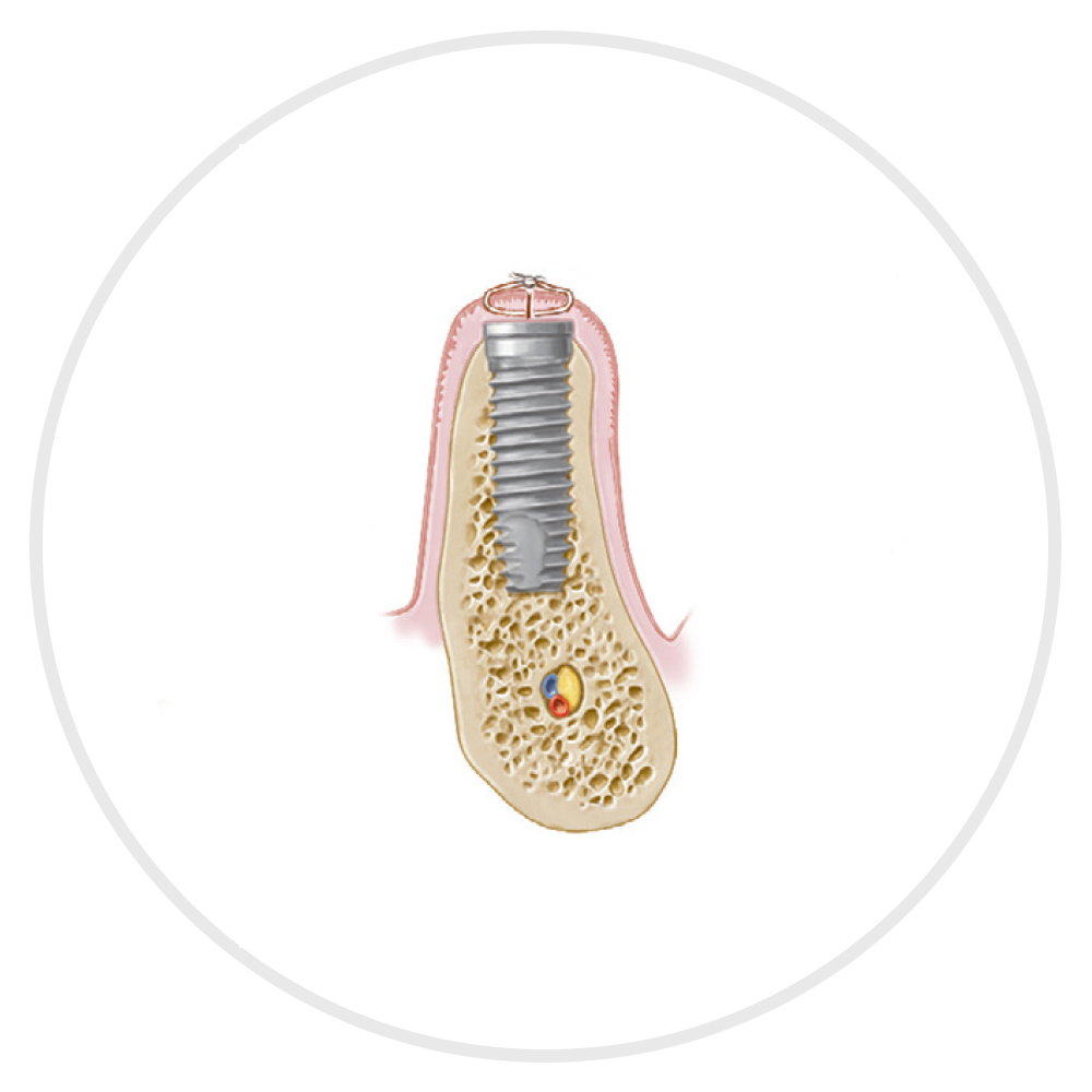 Dental Implants Abroad Cost £400 in Romania - Omnia Dental Clinic